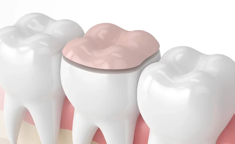 Inlay and Onlay Restorations - Pleasant Ridge Family Dentistry ...